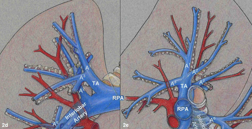 CT Pulmonary Angiography