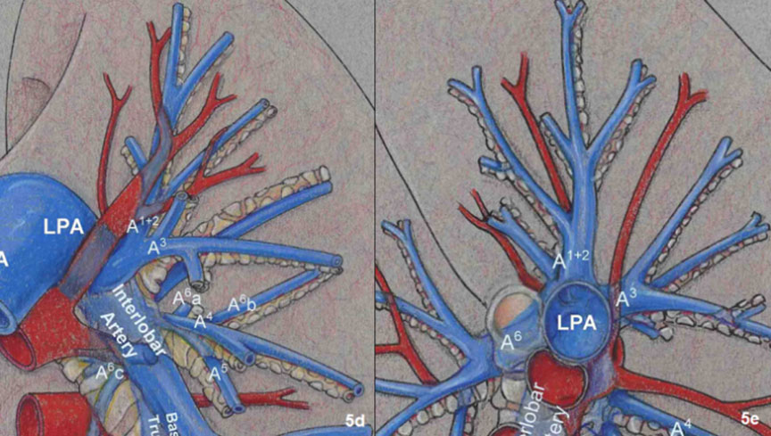 CT Pulmonary Angiography