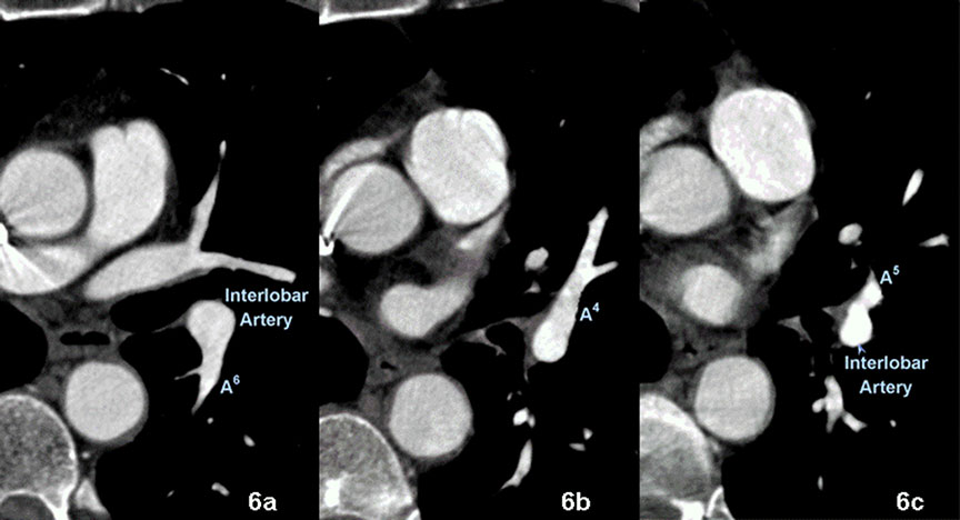 CT Pulmonary Angiography