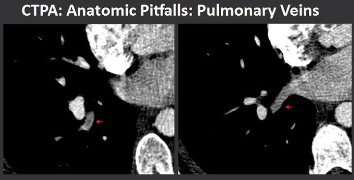 CT Pulmonary Angiography