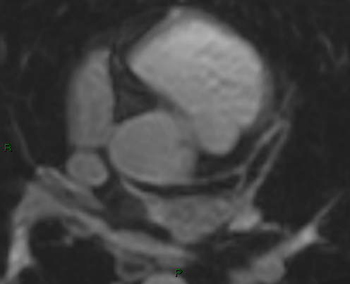 Cardiac MRI